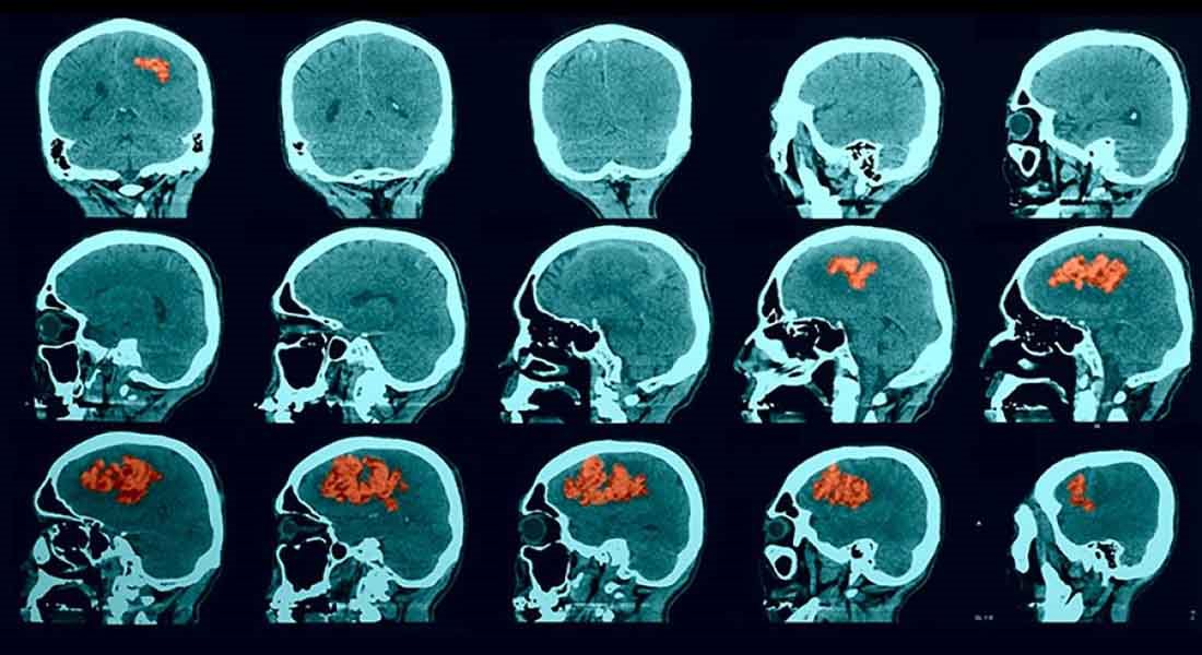Stroke (CVA) | Nerveaide Rehabilitation Systems
